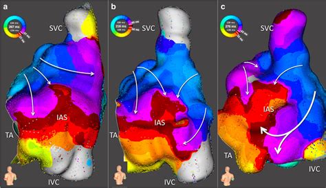 Representative Isochronal Maps Each Color Represents 10 Ms Showing Download Scientific