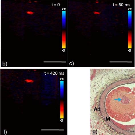 Forward Viewing Oct Scanning Catheter A A Schematic Of The Probe