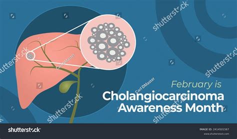 Intrahepatic Cholangiocarcinoma Over 8 Royalty Free Licensable Stock