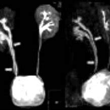 Urorm 2dt2 Que Muestra Hipoplasia Renal Izquierda Download