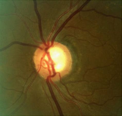 Optic Disc Staging Systems Effective In Grading Advanced Glaucoma