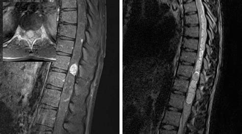 Nontumoural Spinal Cord Lesions Radiology Key