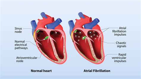 Atrial Fibrillation Vs Ventricular Fibrillation Understanding The Differences Przychodnia