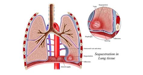 Lung Sequestration New