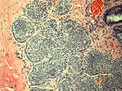 Classic Lcis Lin 1 Hande × 40 Magnification Classic Type Lobular