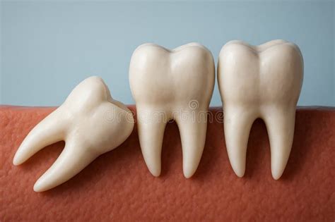 Wisdom Tooth Emerging On Gum Causing Misalignment And Various Dental Issues Leading To The