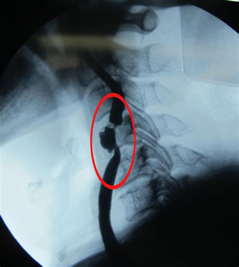双侧颈动脉狭窄 中风网
