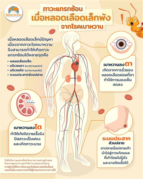 โลกเบาหวาน ภาวะแทรกซ้อน Facebook