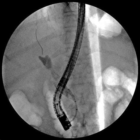 Cholangiography Showed Irregular Filling Defects Within The Entire Download Scientific Diagram