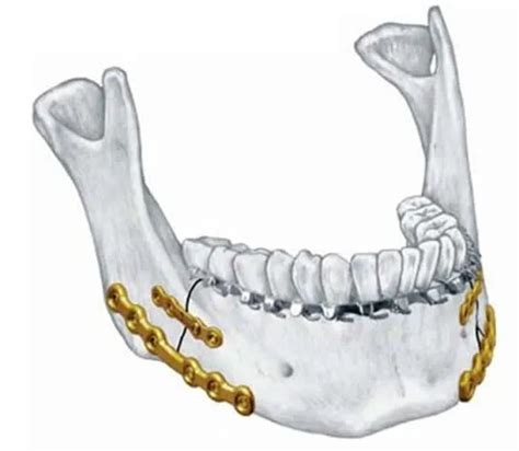 Mandibular Fracture