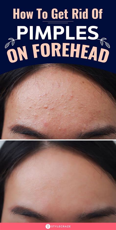 Exemplary Info About How To Get Rid Of Pimples On Your Forehead Blockbath71