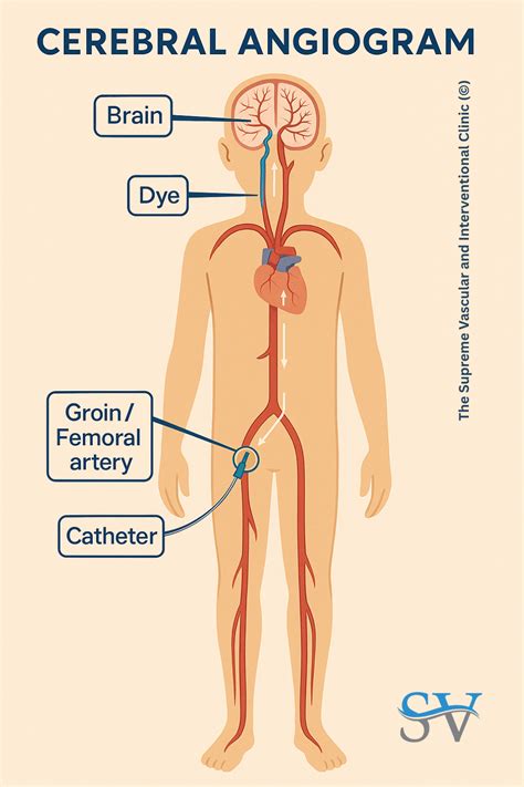 A Visual Guide To Cerebral Angiogram For Brain Aneurysms Supreme Vascular And Interventional