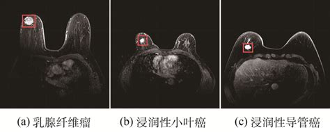基于Gabor特征的乳腺肿瘤MR图像分类识别模型