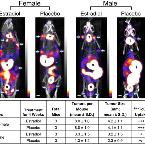 A Chest Computed Tomography Shows Pneumothorax During Chest Tube Download Scientific Diagram