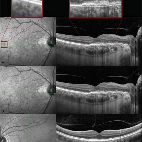 The Sd Oct Through The Central Macula Reveals Disruptions Of The Inner Download Scientific