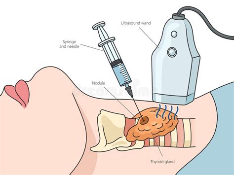 Thyroid Puncture Stock Illustrations 4 Thyroid Puncture Stock