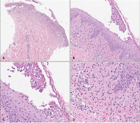 Histopathology Showing A Subcorneal Pustule With Epidermal Spongiosis