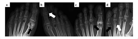 A Bipartite Hallucal Sesamoid B Hallucal Interphalangeal Sesamoid