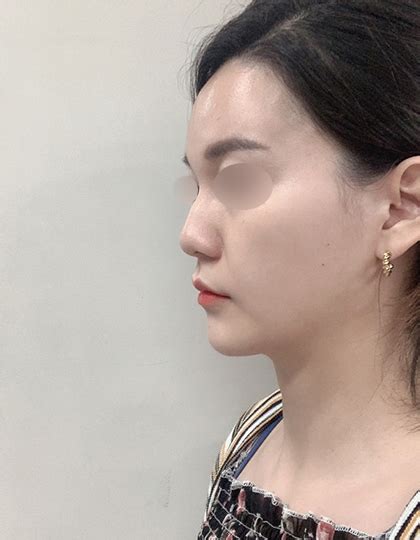 인스타 후기 보고 왔는데 여자코성형후기 리얼셀카후기 삼성드림이비인후과