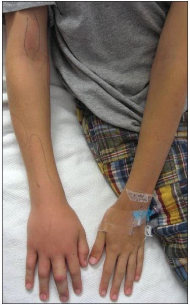 Arm Swelling And Erythema Following Hymenoptera Sting Consultant360