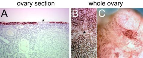 E Cadherin Expression In The Ovarian Surface Epithelial Cells