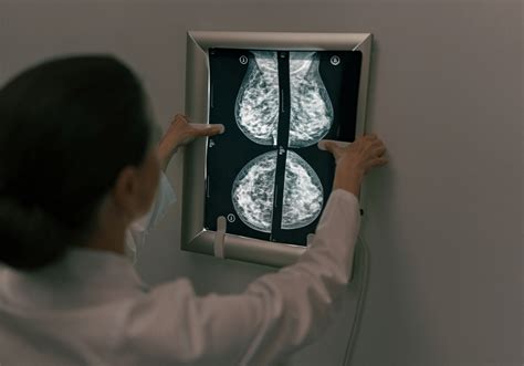 Breast Arterial Calcifications For Cardiovascular Disease Risk Stratification In Women