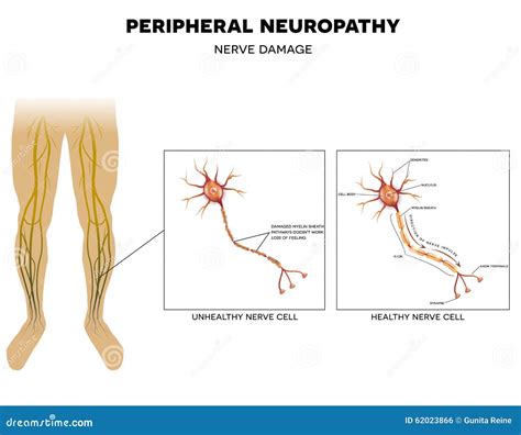Neuropathy Nerve Damage Stock Vector Image 62023866