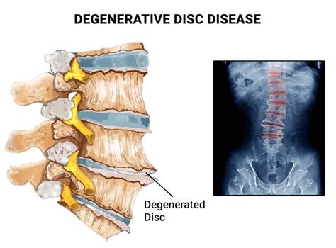 Degenerative Disc In Thoracic Spine