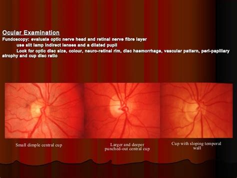 Anatomy Of The Angle Structure Glaucoma