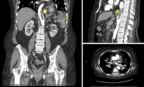 Computed Tomography Angiogram Showing Extensive Intra Abdominal Download Scientific Diagram