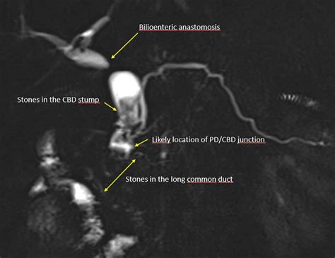 Biliary Magnetic Resonance Imaging Showing Stones In The Lower Part Of Download Scientific