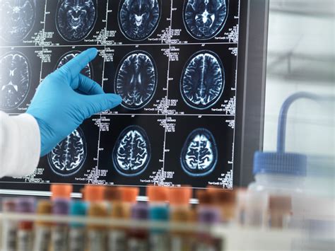 경도인지장애의 원인 ‘이 호르몬에 있다 당신의 건강가이드 헬스조선