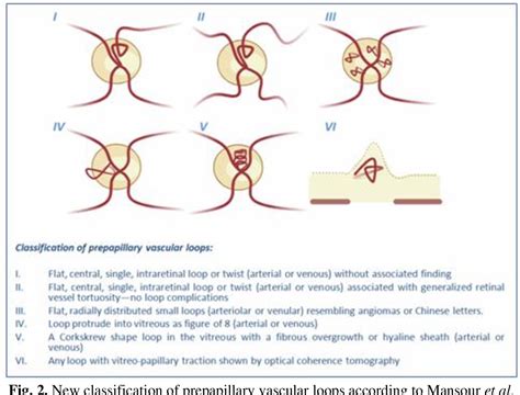 Prepapillary Vascular Loop In A Girl With Ventricular Septal Defect Prepapillary Vascular Loop In A Girl With Ventricular Septal Defect