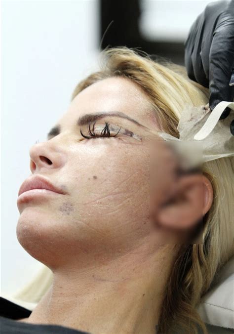 Rùng mình trước gương mặt biến dạng của bom sex nước Anh vết dao kéo mưng mủ gây ám ảnh