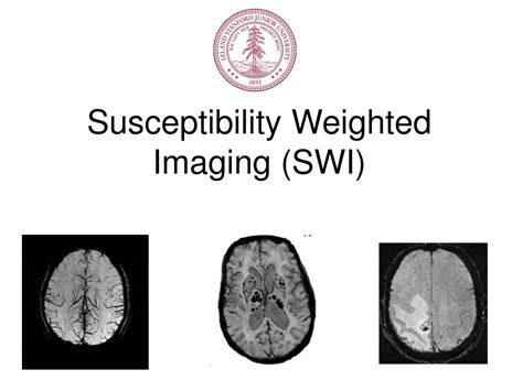 Ppt Susceptibility Weighted Imaging Swi Powerpoint Presentation Free Download Id331635
