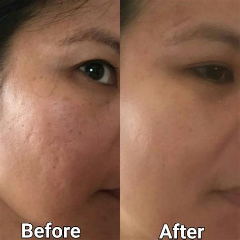 Microneedling Nose Microneedling So Gut Funktioniert Es Wirklich Pben