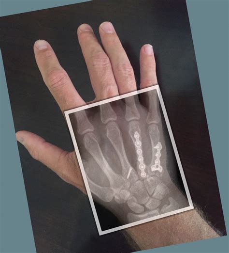 Metacarpal Fracture Treatment In Raleigh Nc By Dr Erickson