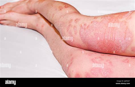 Acute Psoriasis Severe Reddening Of The Skinan Autoimmuneincurable