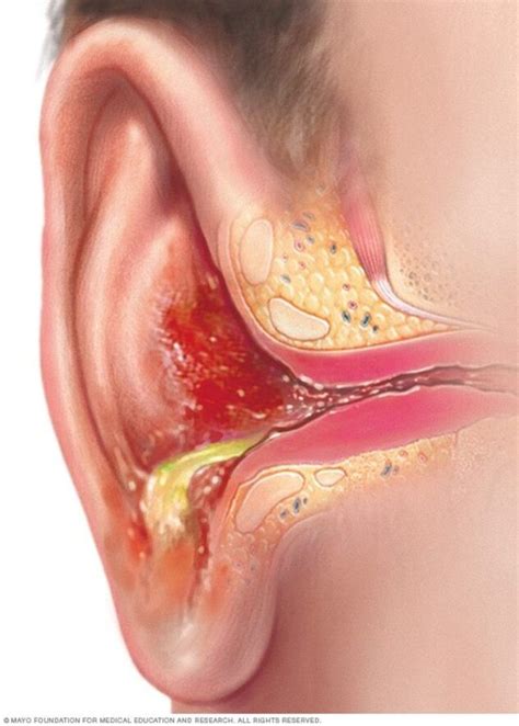 A Guide To External Ear Infections From An Ent Specialist In Singapore