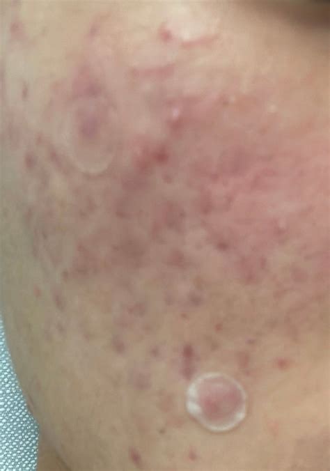 학생여드름 지식in