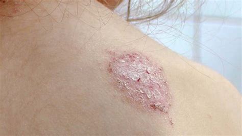 Ringworm Vs Eczema Symptoms Causes Treatments
