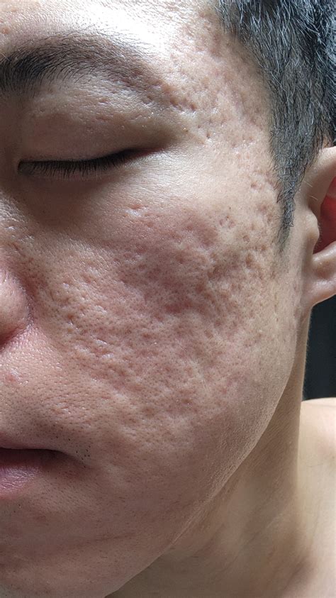 여드름 흉터 서브시전 문의 에스앤유 김방순 피부과