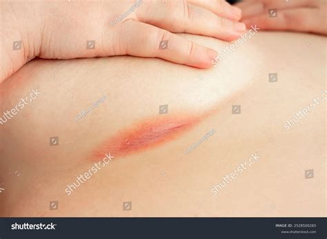Intertrigo Rash On Elderly Woman39s Groin Stock Image Intertrigo