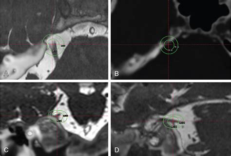 Idiopathic Trigeminal Neuralgia Upfront Radiosurgery Radiology Key