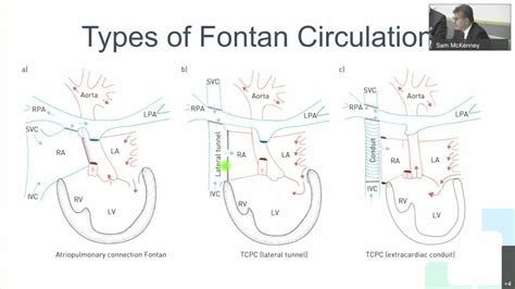 Failed Fontan Ventricular Conversion And Implications For Future Pregnancy Youtube