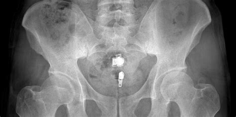 Bilateral Sacroileitis On X Ray Figure 2 Bilateral Sacroiliac Bone