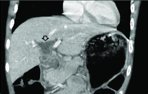 Computed Tomography Image With Open Dark Arrow Demonstrating Central Download Scientific