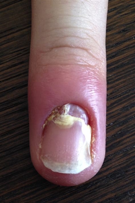 Bacterial And Viral Infections Of The Nail Unit Dermatologic Clinics