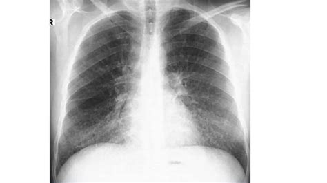 Obstructive Vs Restrictive Pulmonary Disease Pathology Atot Pptx