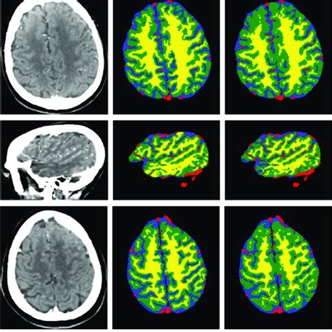 Pdf Multiclass Brain Tissue Segmentation In 4d Ct Using Convolutional Neural Networks